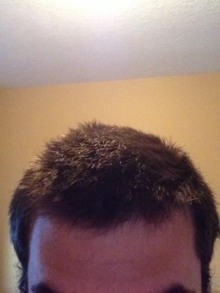 Bald Truth Talk - Hair Loss, Hair Transplant and Hair Restoration Community