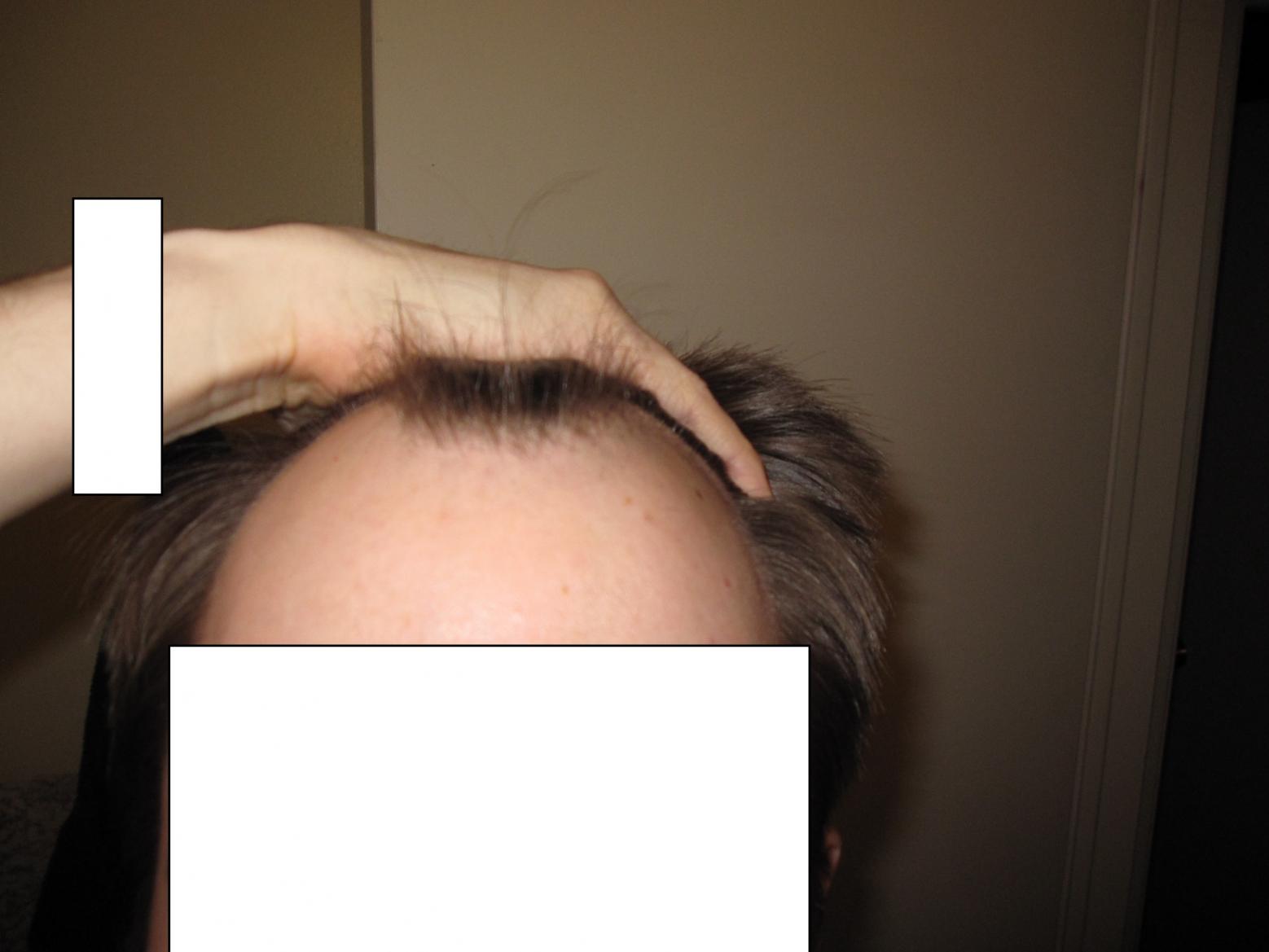 My Propecia Results + Side Effects (Followed Over 1 Year) - Bald Truth ...