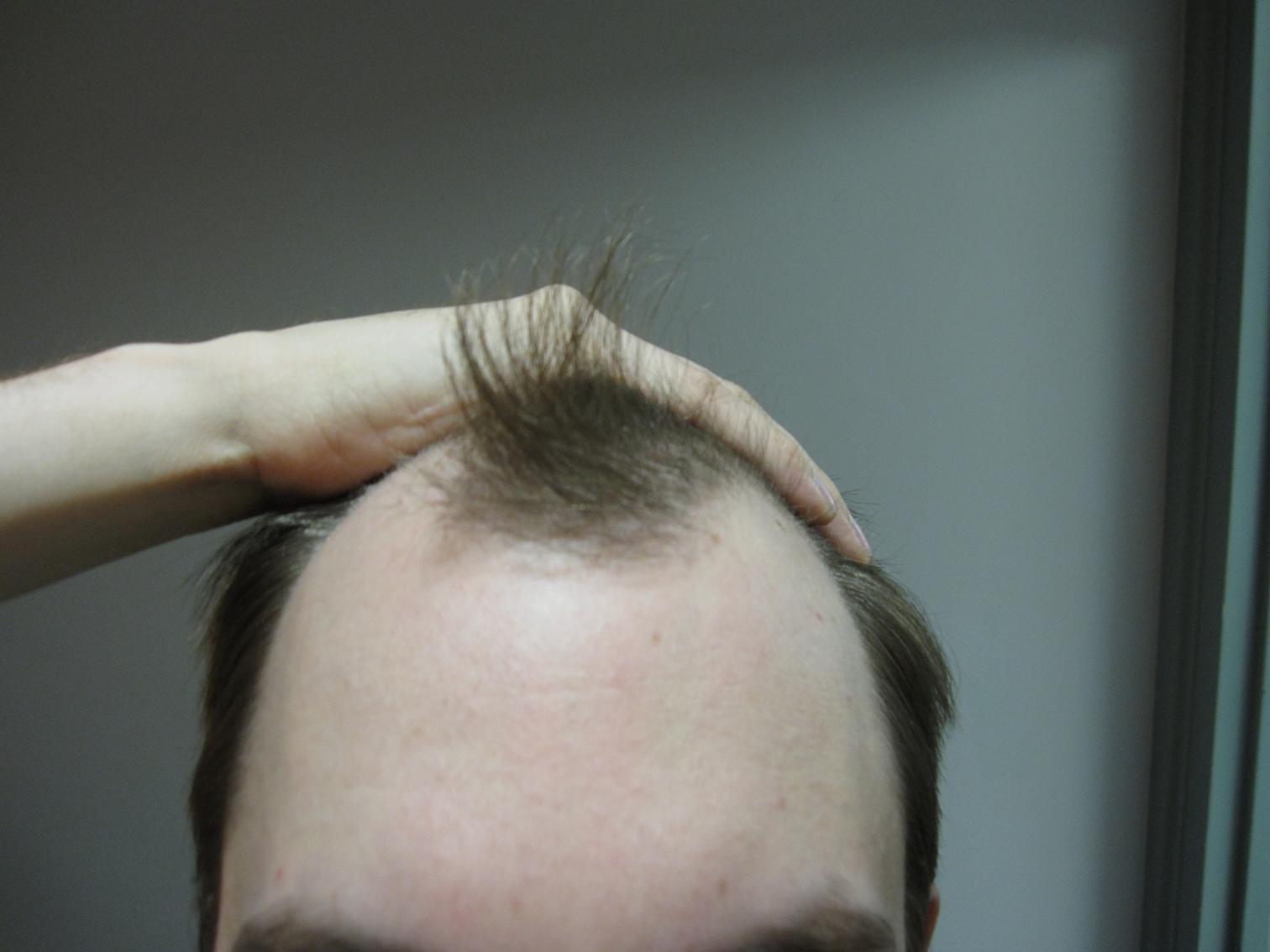 My Propecia Results + Side Effects (Followed Over 1 Year) - Bald Truth ...